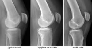 Instabilité de rotule – Versailles Arthroscopie Orthopédie – Centre ...