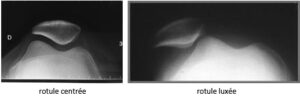 Instabilité de rotule – Versailles Arthroscopie Orthopédie – Centre ...